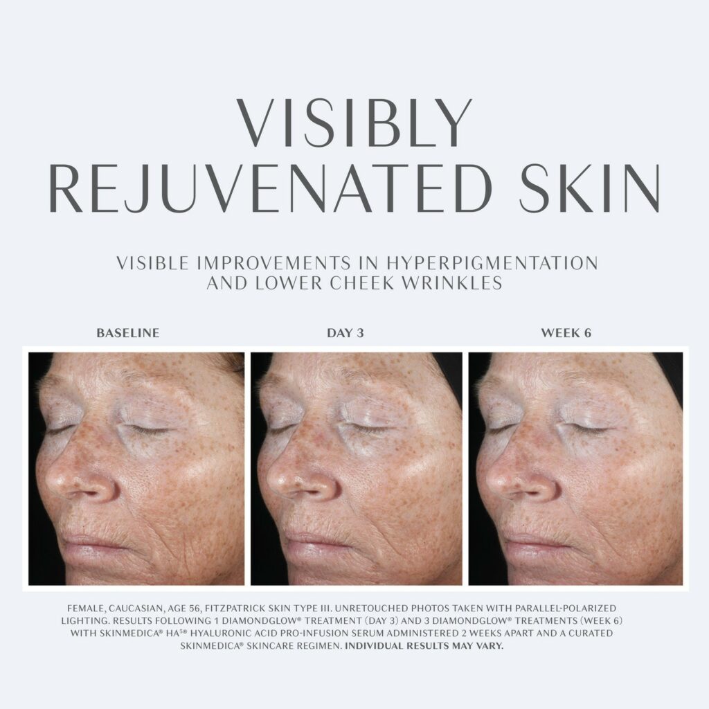 Diamond Glow SkinMedica Dermal Infusion Facials - Cadella Aesthetics